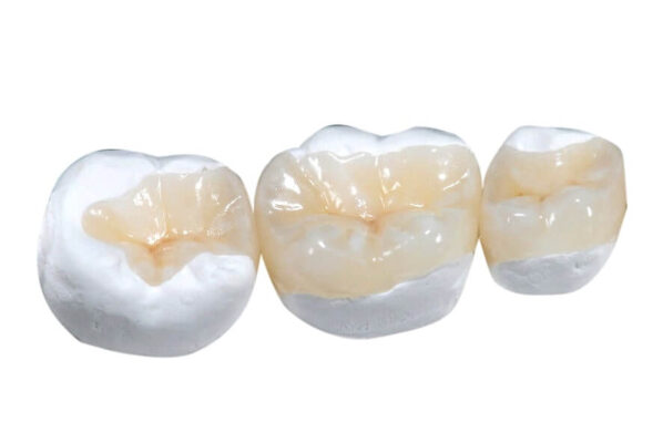 E.MAX INLAY - ONLAY - Lavina