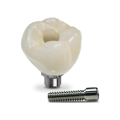 SCREW-RETAINED CROWNS - Lavina